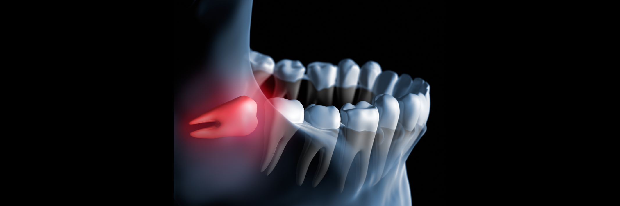 Never Ignore an Impacted Wisdom Tooth - Kalyani Dental Lounge